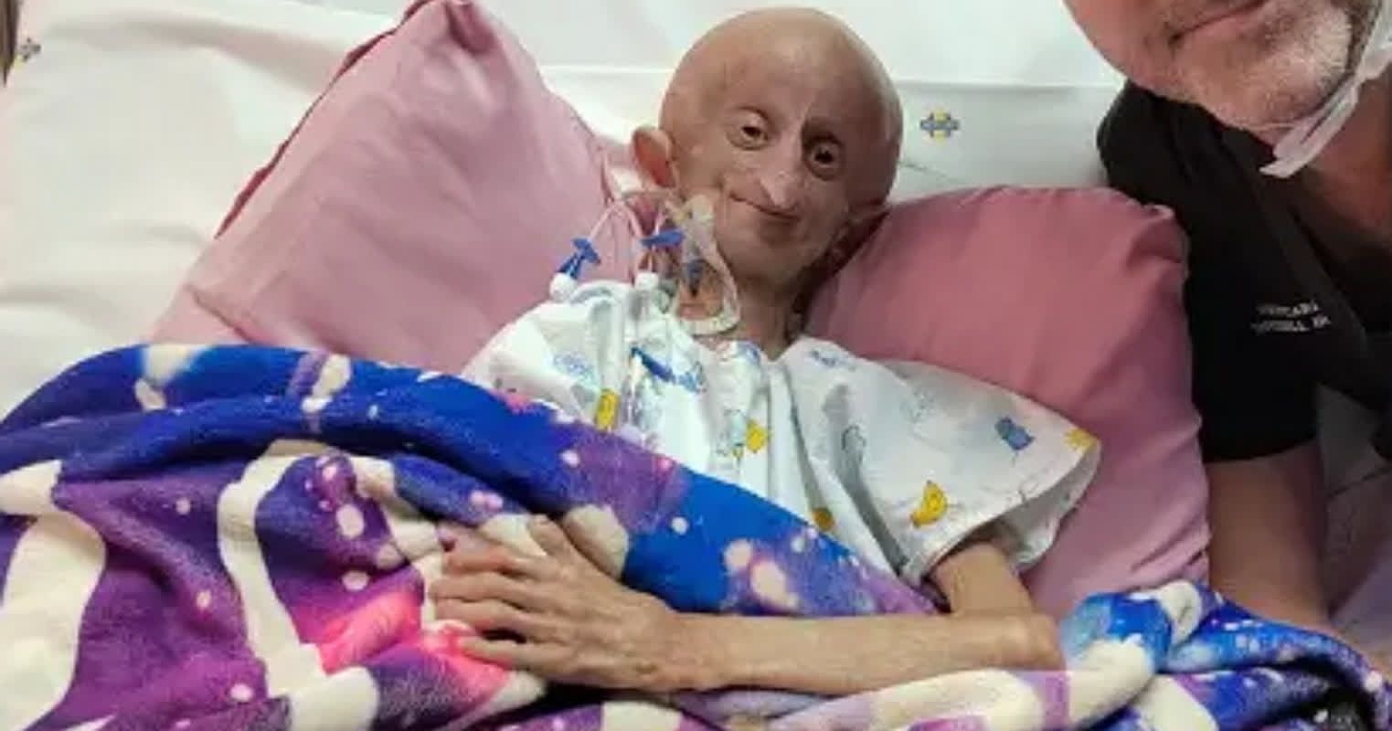 TikTok Star with Progeria Inspires Millions Before Passing at 19